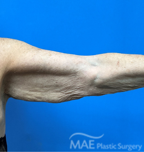 Arm Lift Archives - MAE Plastic Surgery - Chicago, IL