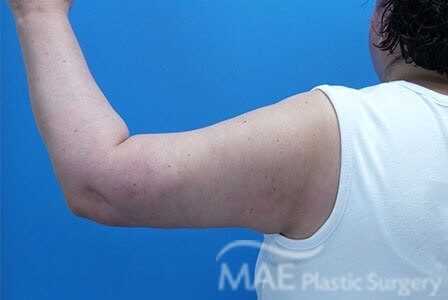 Arm Lift Case 1384 - MAE Plastic Surgery - Chicago, IL