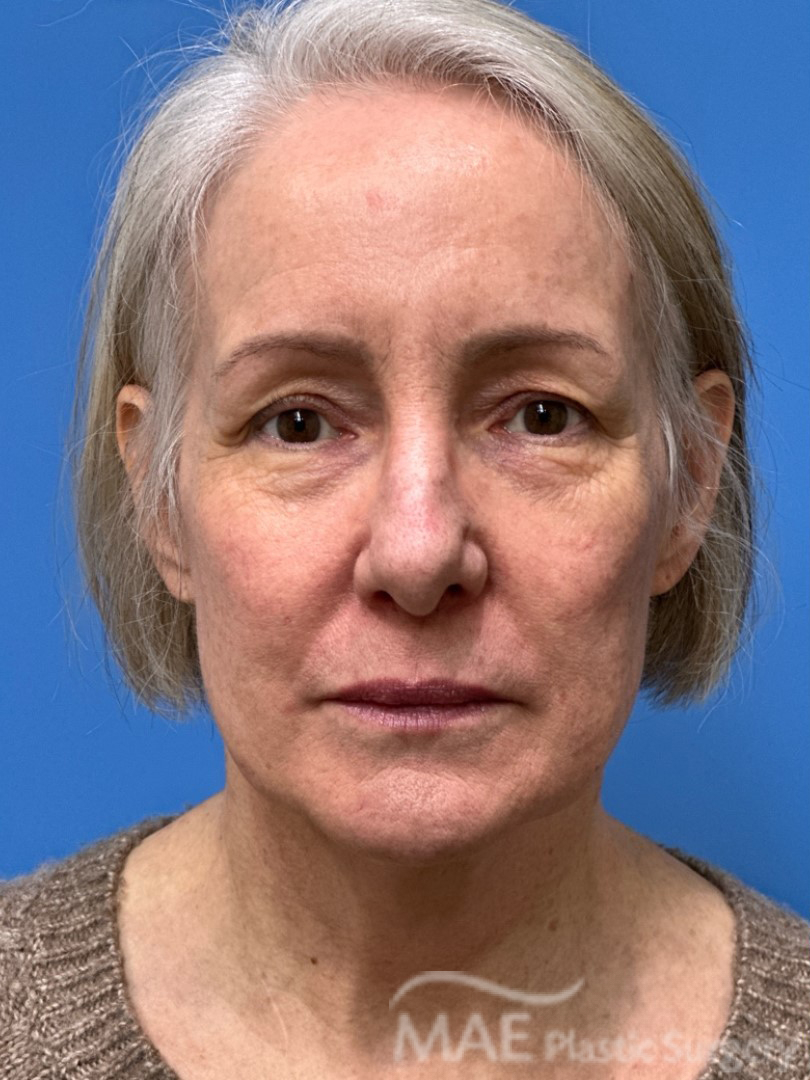 Facelift Lift Photo Gallery Chicago | MAE Plastic Surgery