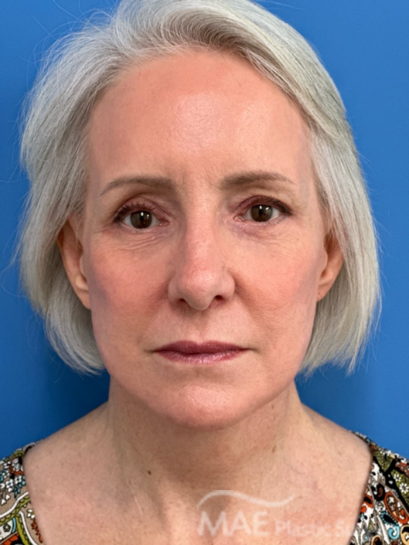 Facelift Lift Photo Gallery Chicago | MAE Plastic Surgery