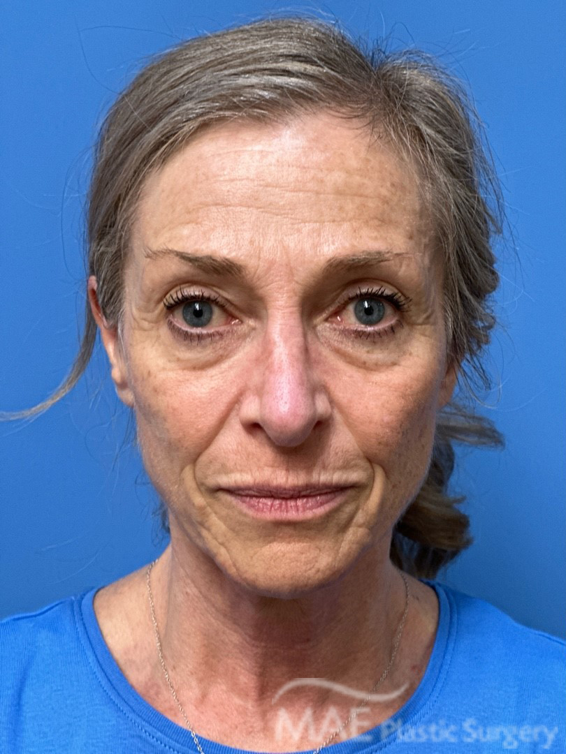 Facelift Case 25994 - MAE Plastic Surgery - Chicago, IL
