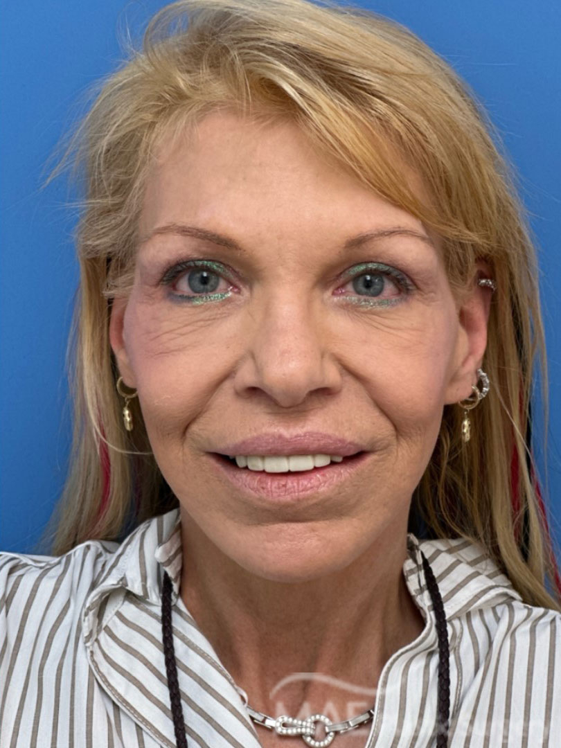 Facelift Case # HB3441 - MAE Plastic Surgery - Chicago, IL