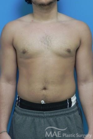 Gynecomastia Surgery Before & After | MAE Plastic Surgery