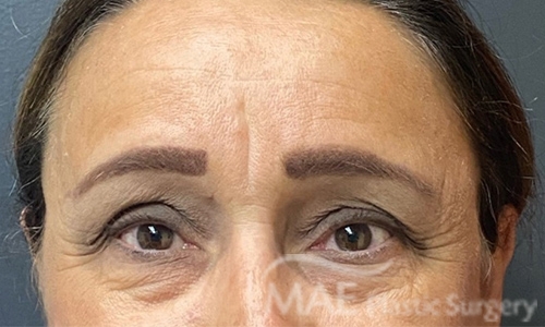 Injectables Archives - MAE Plastic Surgery - Chicago, IL