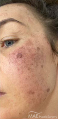 IPL Archives - MAE Plastic Surgery - Chicago, IL