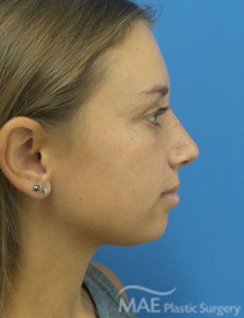Signs You May Need Functional Rhinoplasty - MAE Plastic Surgery ...