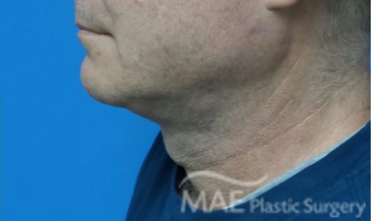 Radio Frequency Liposuction Photo Gallery | MAE Plastic Surgery