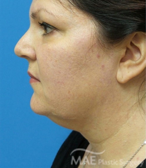 Radio Frequency Liposuction Photo Gallery | MAE Plastic Surgery