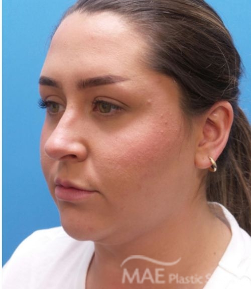 SkinTite - RFAL Case 21972 - MAE Plastic Surgery - Chicago, IL