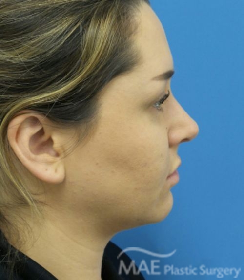 Radio Frequency Liposuction Photo Gallery | MAE Plastic Surgery