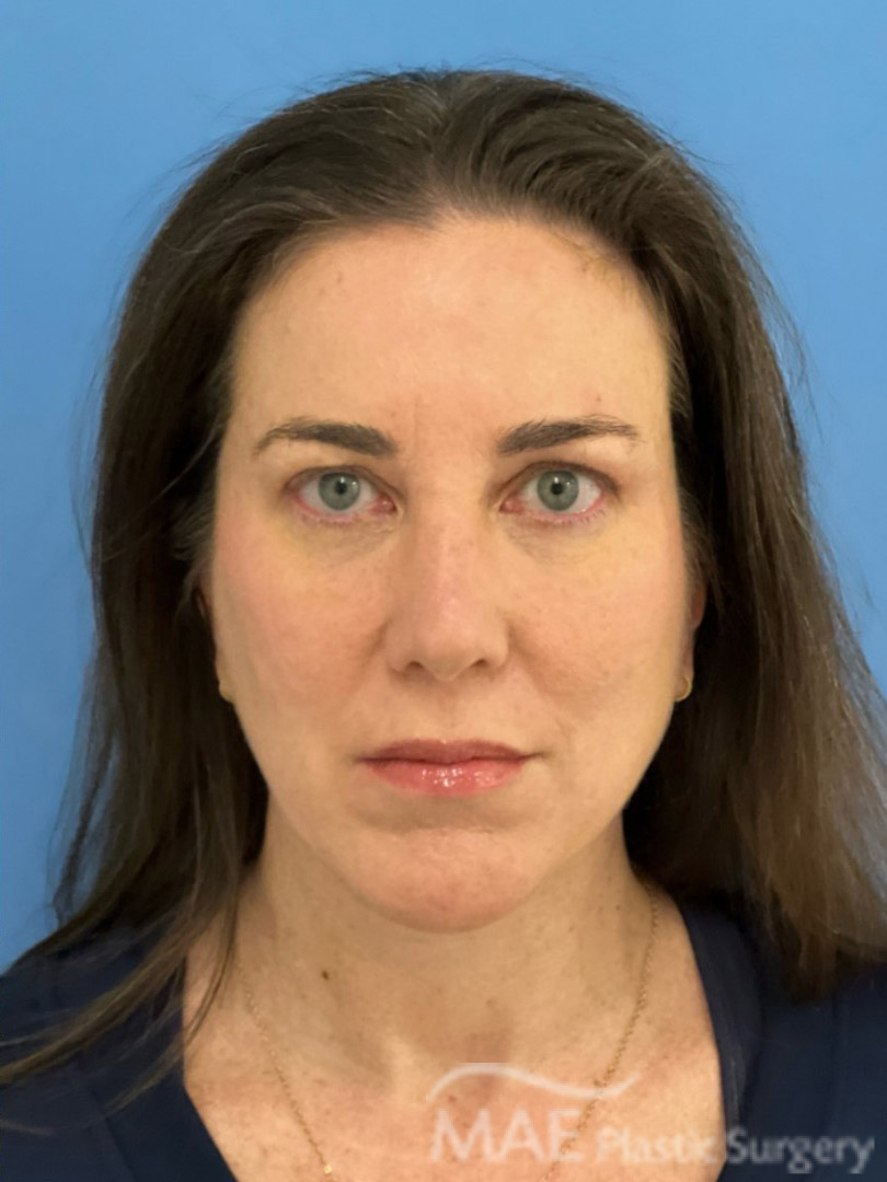 Radio Frequency Liposuction Photo Gallery | MAE Plastic Surgery