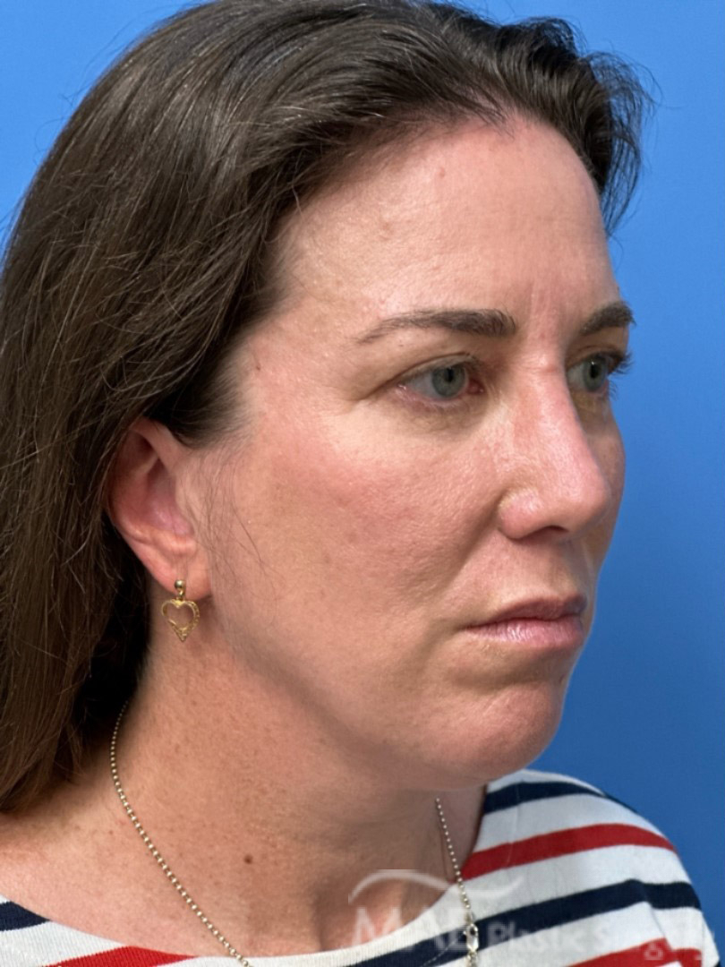 Skintite Case 46665 - MAE Plastic Surgery - Chicago, IL