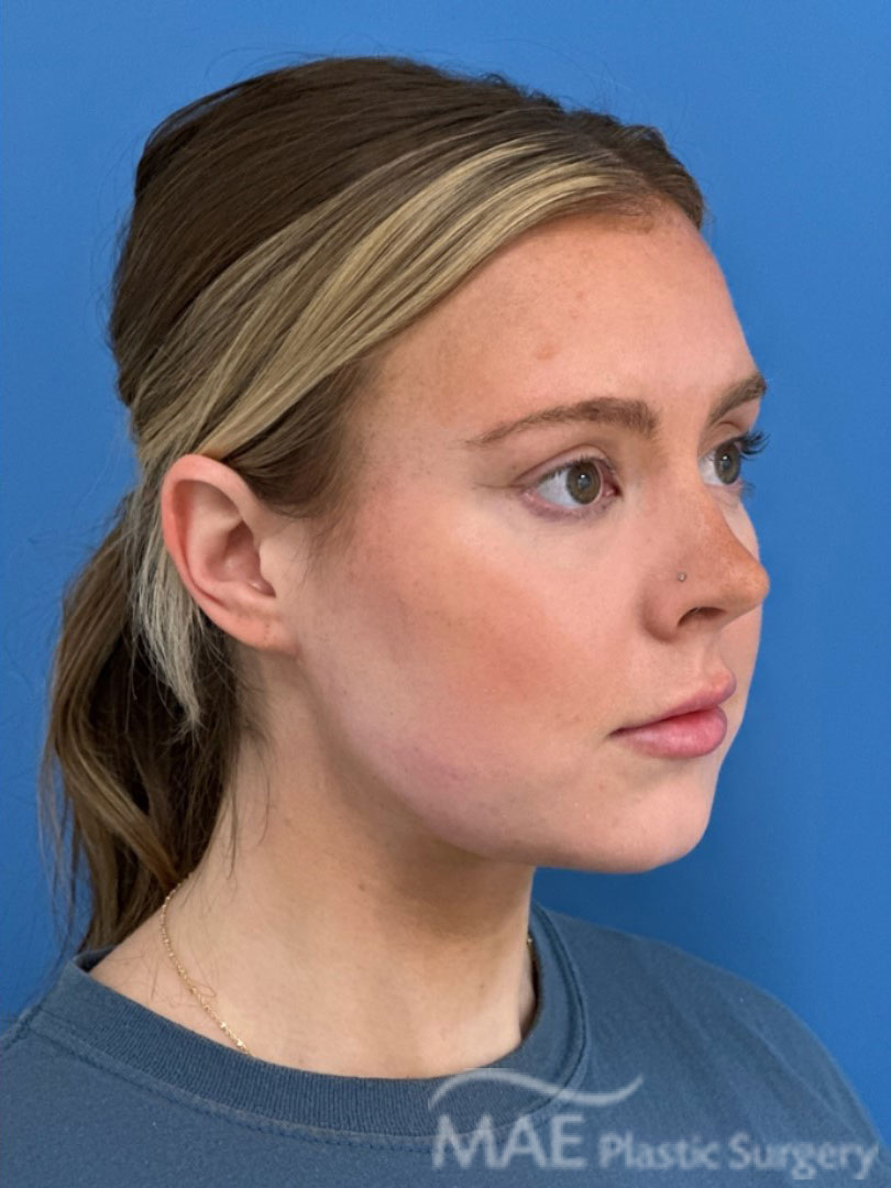 Liposuction Case 47221 - MAE Plastic Surgery - Chicago, IL
